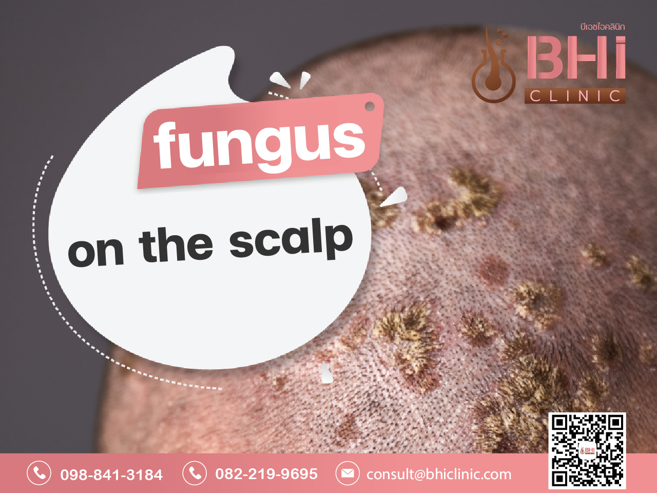 fungus on the scalp - BHI Clinic